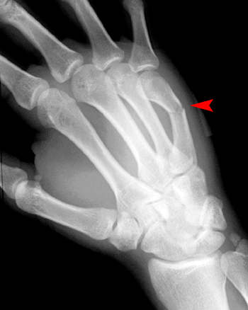 BOXERS FRACTURE - Texas Orthopedic and Spine Associates