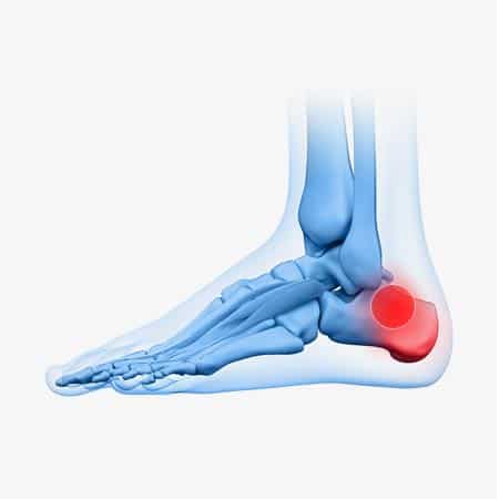 CALCANEAL OSTEOTOMY - Texas Orthopedic and Spine Associates