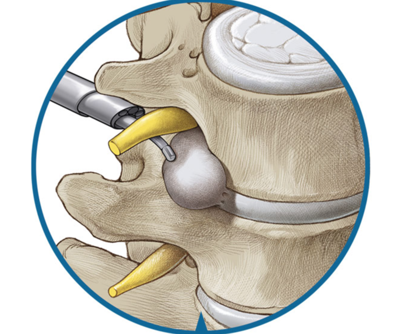FORAMINOTOMY - Texas Orthopedic and Spine Associates