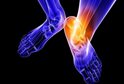 ANKLE SYNDESMOSIS - Texas Orthopedic and Spine Associates