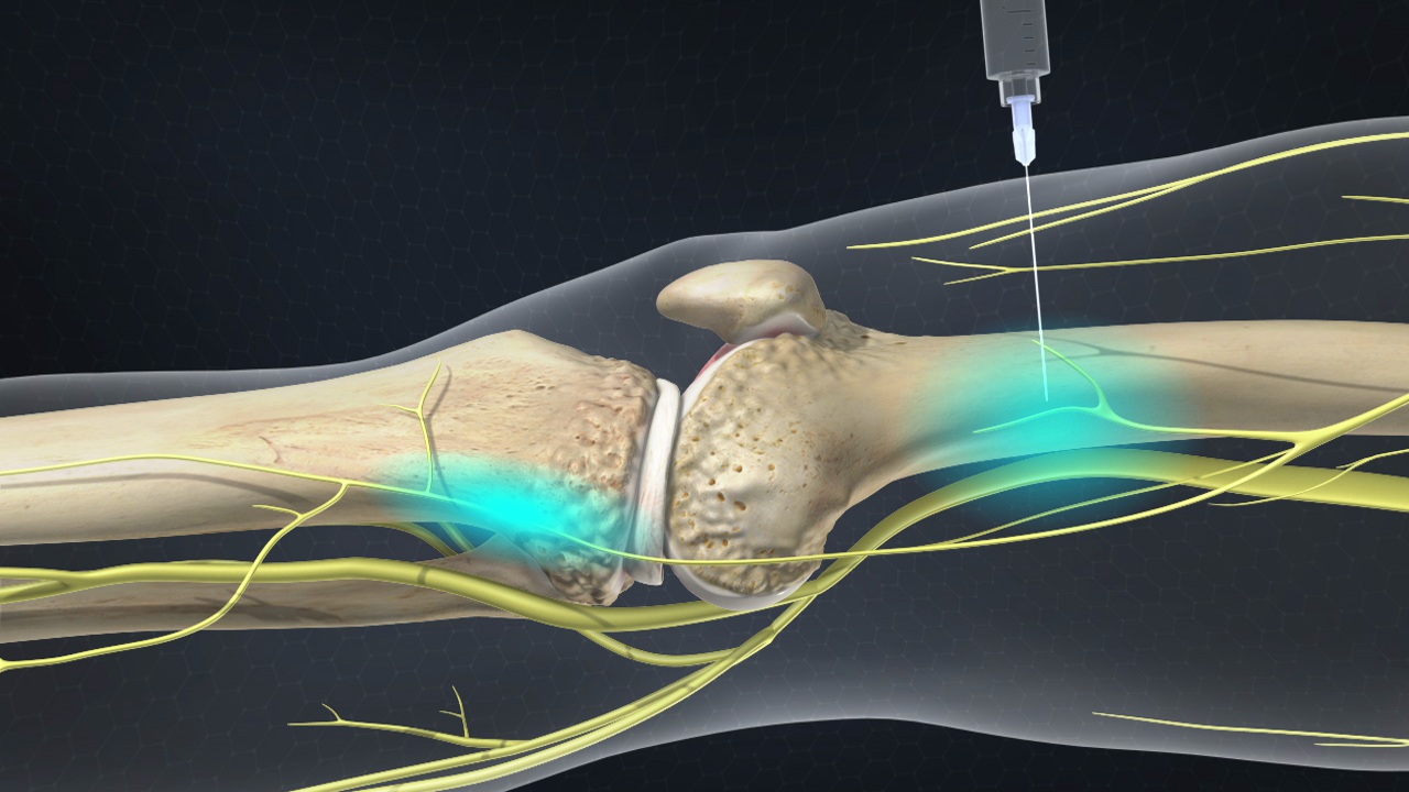 GENICULAR NERVE BLOCK - Texas Orthopedic and Spine Associates