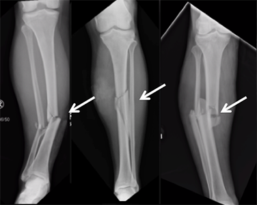 Tibial Fractures - Texas Orthopedic and Spine Associates