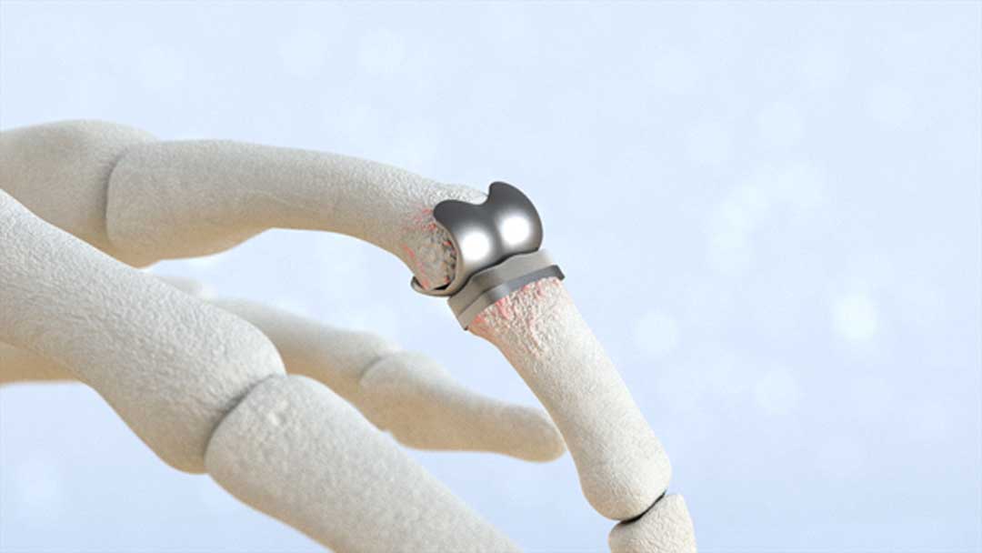 Finger Joint Replacement - Texas Orthopedic and Spine Associates