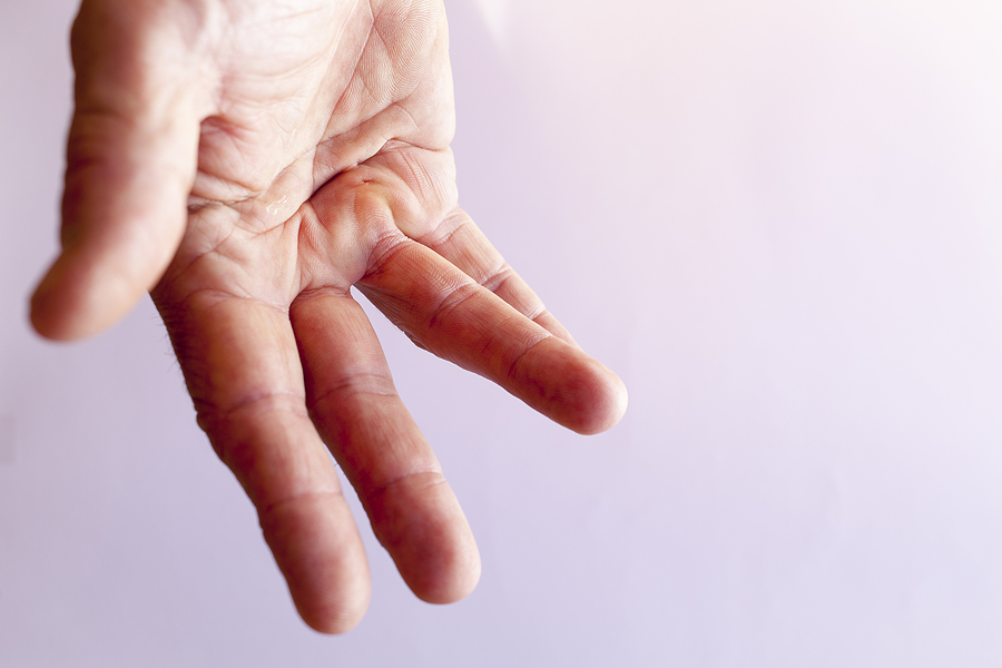 Finger Contracture, Bent Finger - TXOSA