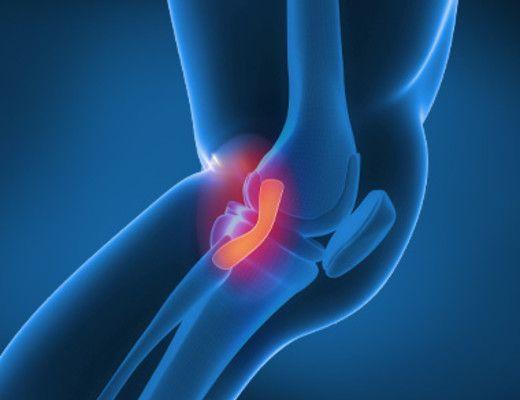 MCL Sprain - Texas Orthopedic and Spine Associates