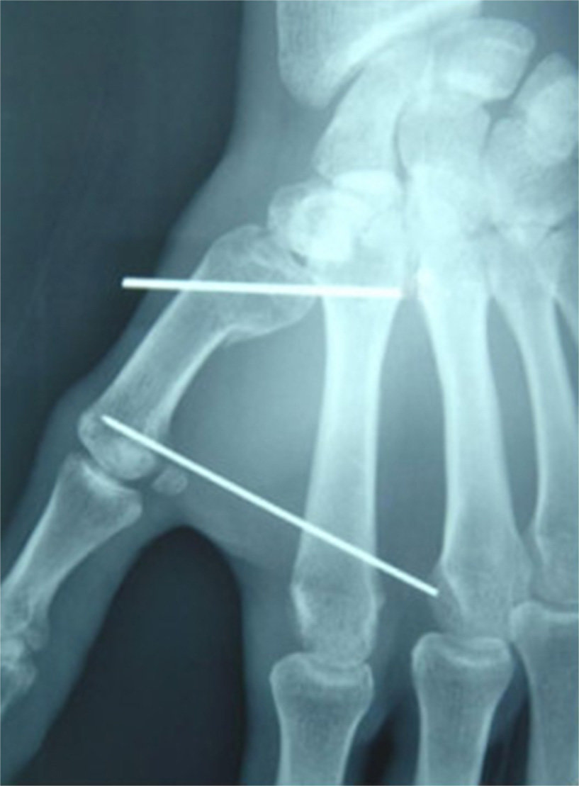 bennett fracture