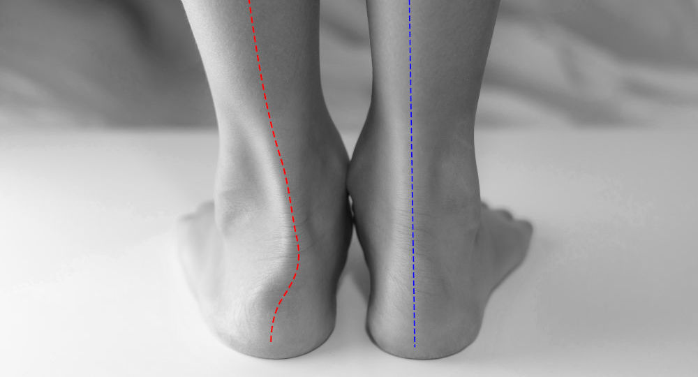 Flat Foot Reconstruction - Texas Orthopedic and Spine Associates