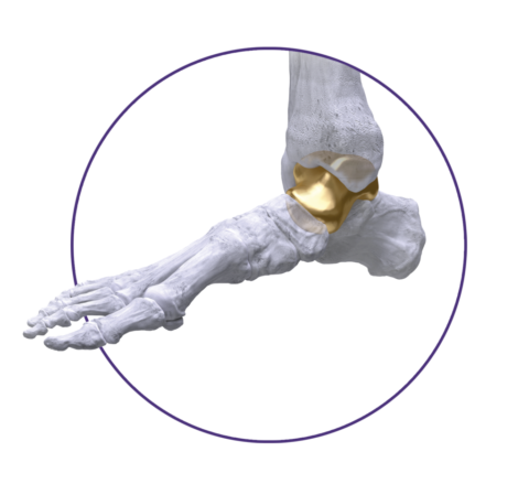 TOTAL TALUS REPLACEMENT - Texas Orthopedic and Spine Associates