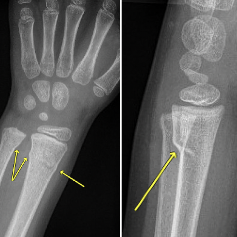 Buckle fractures - Texas Orthopedic and Spine Associates
