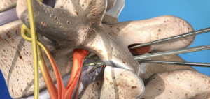 Lumbar Microdiscectomy - Texas Orthopedic and Spine Associates