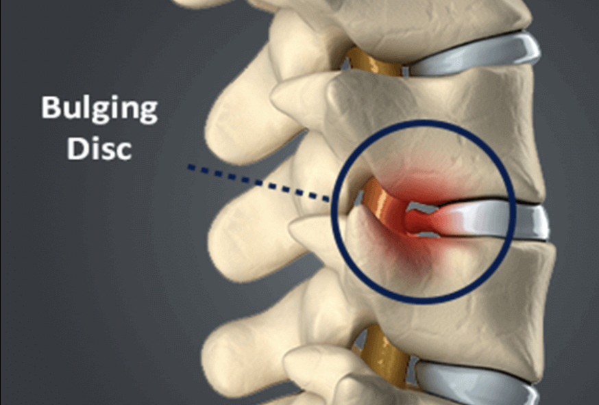 Bulging Disc - Texas Orthopedic and Spine Associates