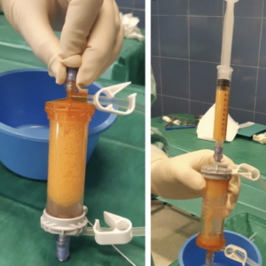 Lipogems - Texas Orthopedic and Spine Associates