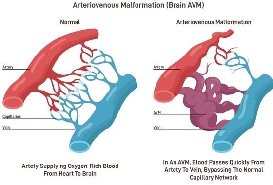 Arteriovenous malformation - Texas Orthopedic and Spine Associates